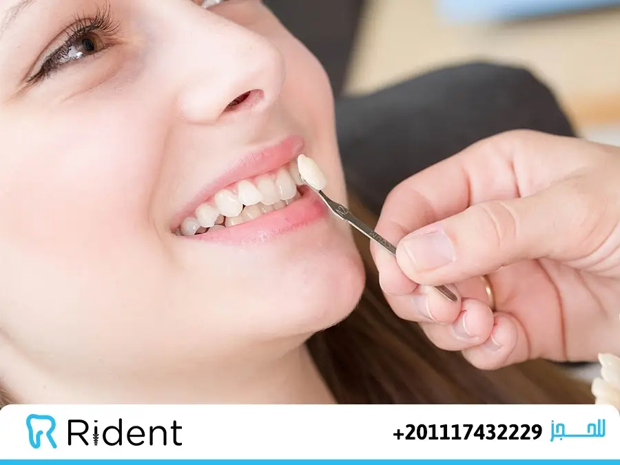 تجربتي مع الفينير في مصر 2024 Rident Dental Centers